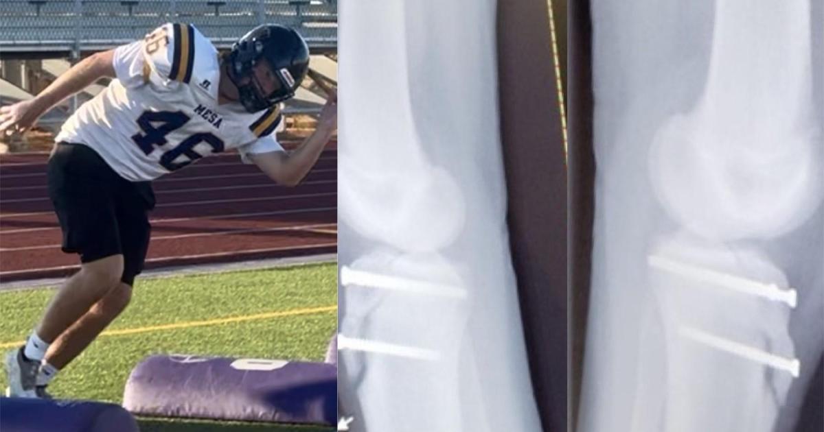 Mesa High senior lands on both feet after breaking both legs | AZPreps365